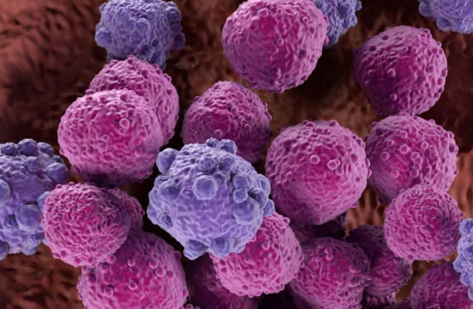 CheckMate 8HW Shows Ipilimumab Plus Nivolumab Improves PFS in ...