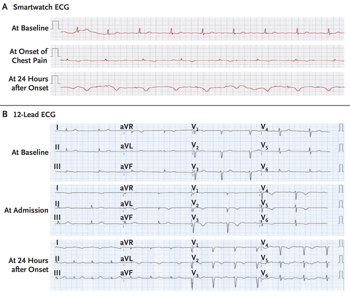 Men More Likely to Die From Takotsubo Cardiomyopathy, Diagnosed by ...