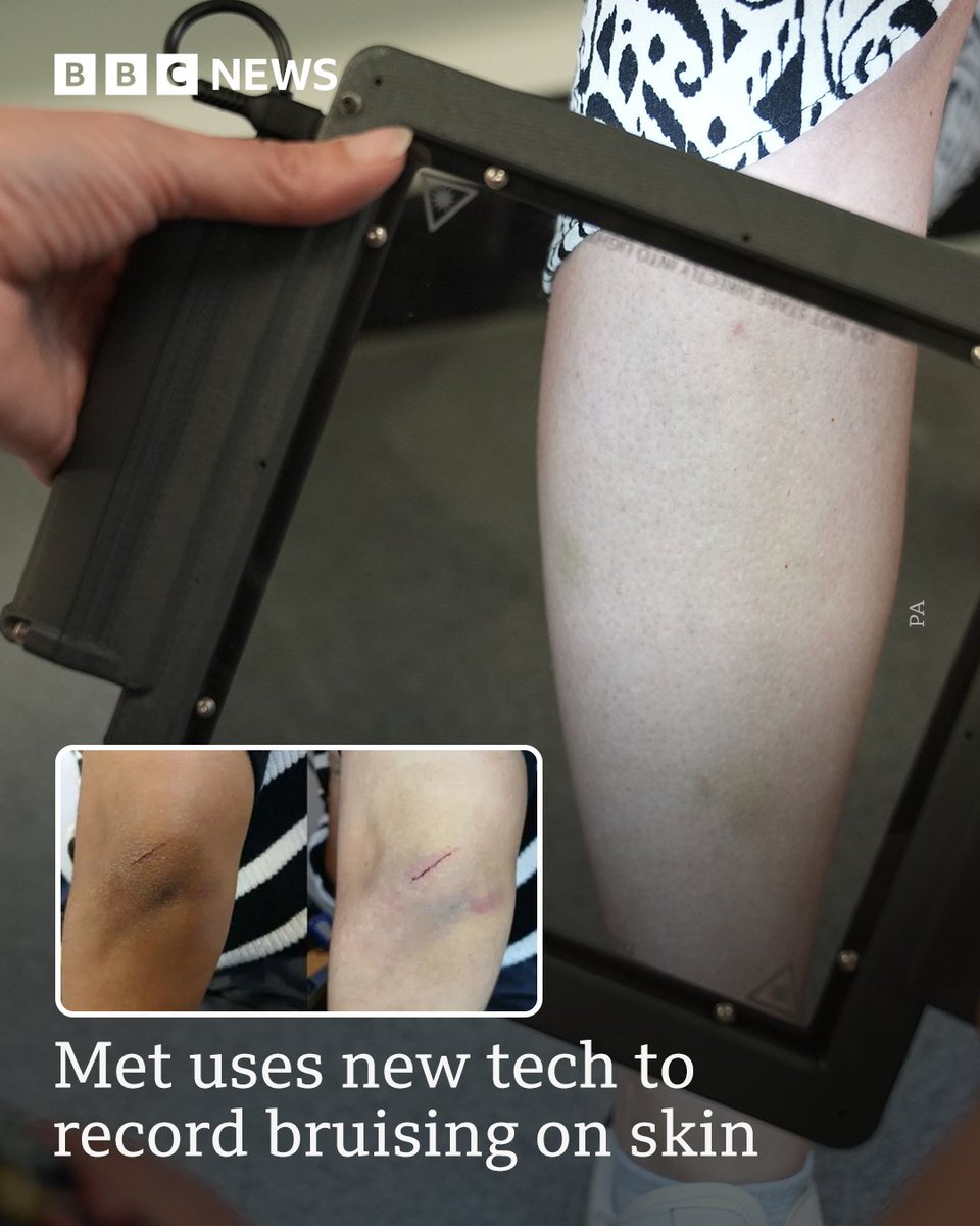 Met Police Introduce Forensic Tech to Detect Bruising on Darker Skin ...