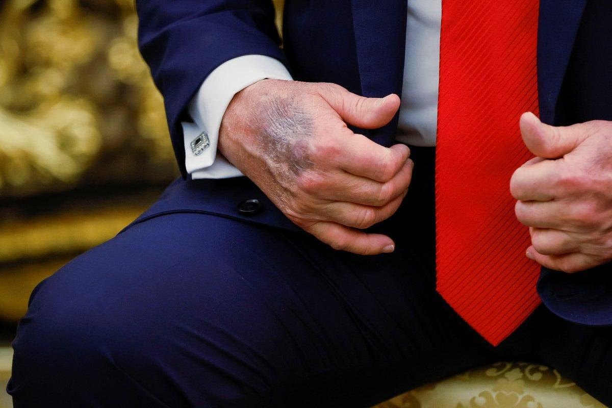 New Trump Hand Bruises Rekindle Questions Over President’s Health ...