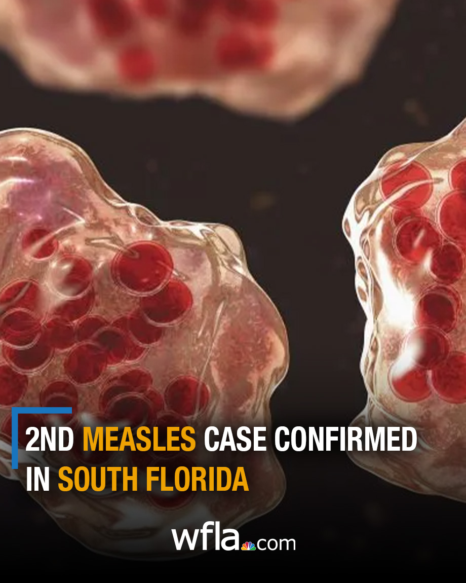 Second Measles Case in South Florida 2025 Confirmed in Broward County ...