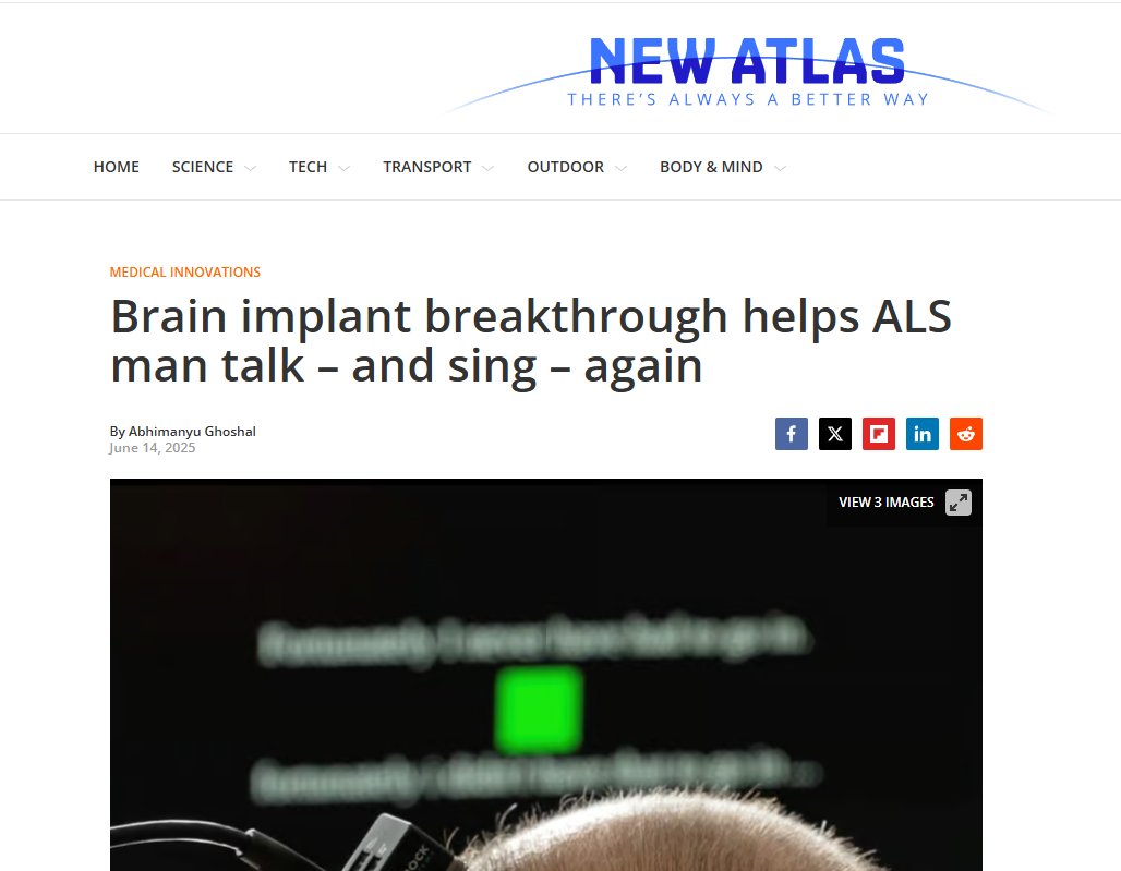 UC Davis Brain-Computer Interface Enables Real-Time Speech and Singing for ALS Patient With 10 ...